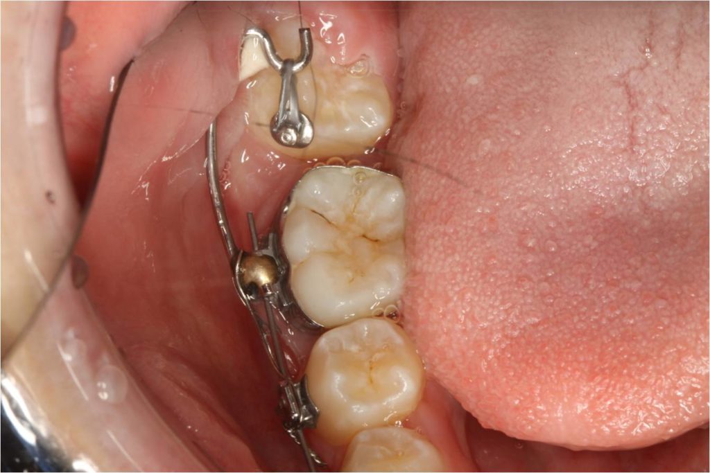 Practice Tip #1 - How to upright a mesially inclined second molar ...
